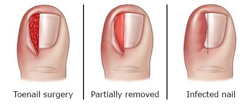 Ingrown Toenail Problems Almawi Limited The Holistic Clinic