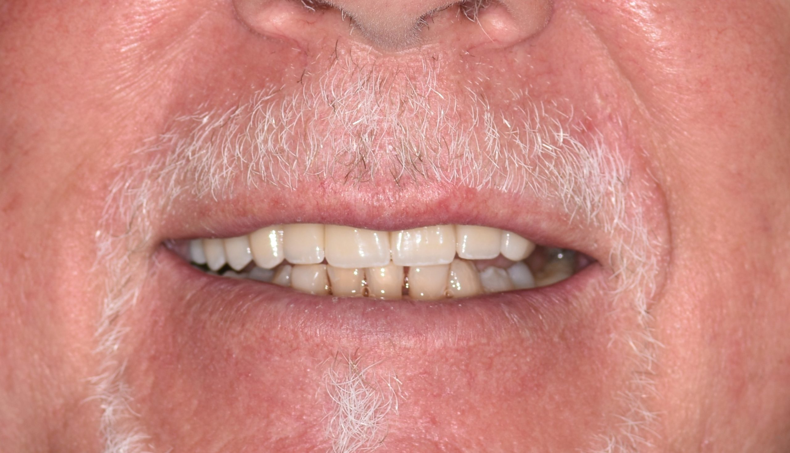 Full Mouth Rehabilitations Aragon Prosthodontics