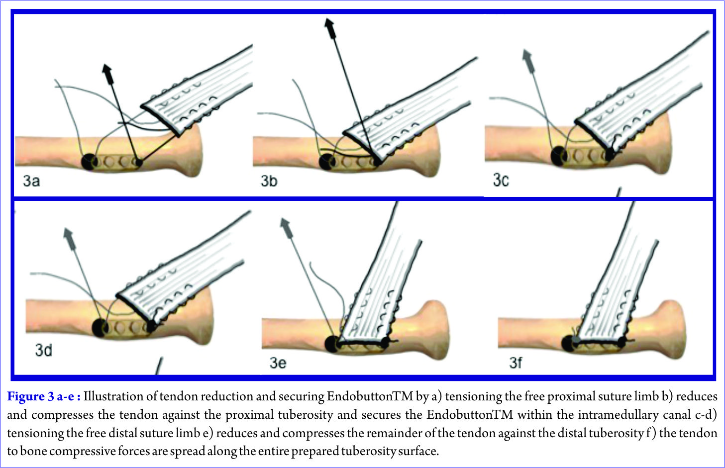 Intramedullary Cortical Button Fixation Of Distal Biceps Tendon Rupture