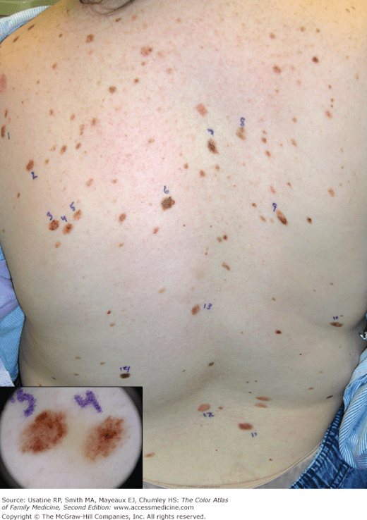 Dysplastic Nevus Basicmedical Key