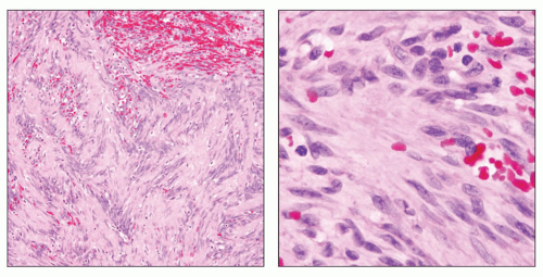 Interdigitating Dendritic Cell Sarcoma Basicmedical Key