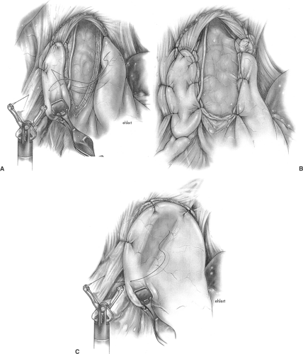 Laparoscopic Hiatal Hernia Repair Basicmedical Key