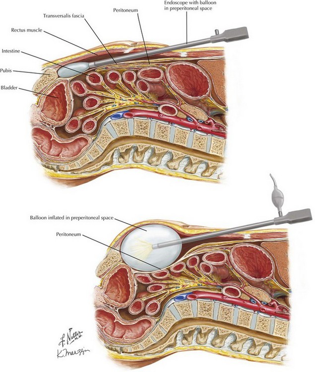 Open Inguinal Hernia Repair Basicmedical Key