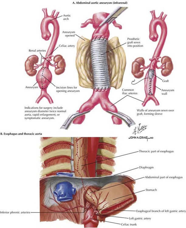 Open Inguinal Hernia Repair Basicmedical Key