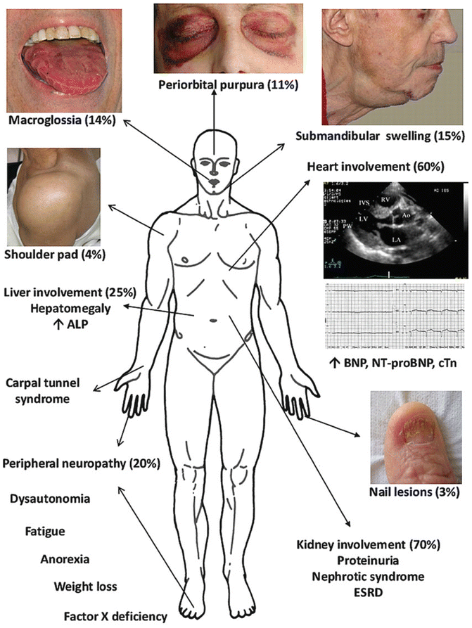 Amyloid Diseases At The Molecular Level General Overview And Focus On