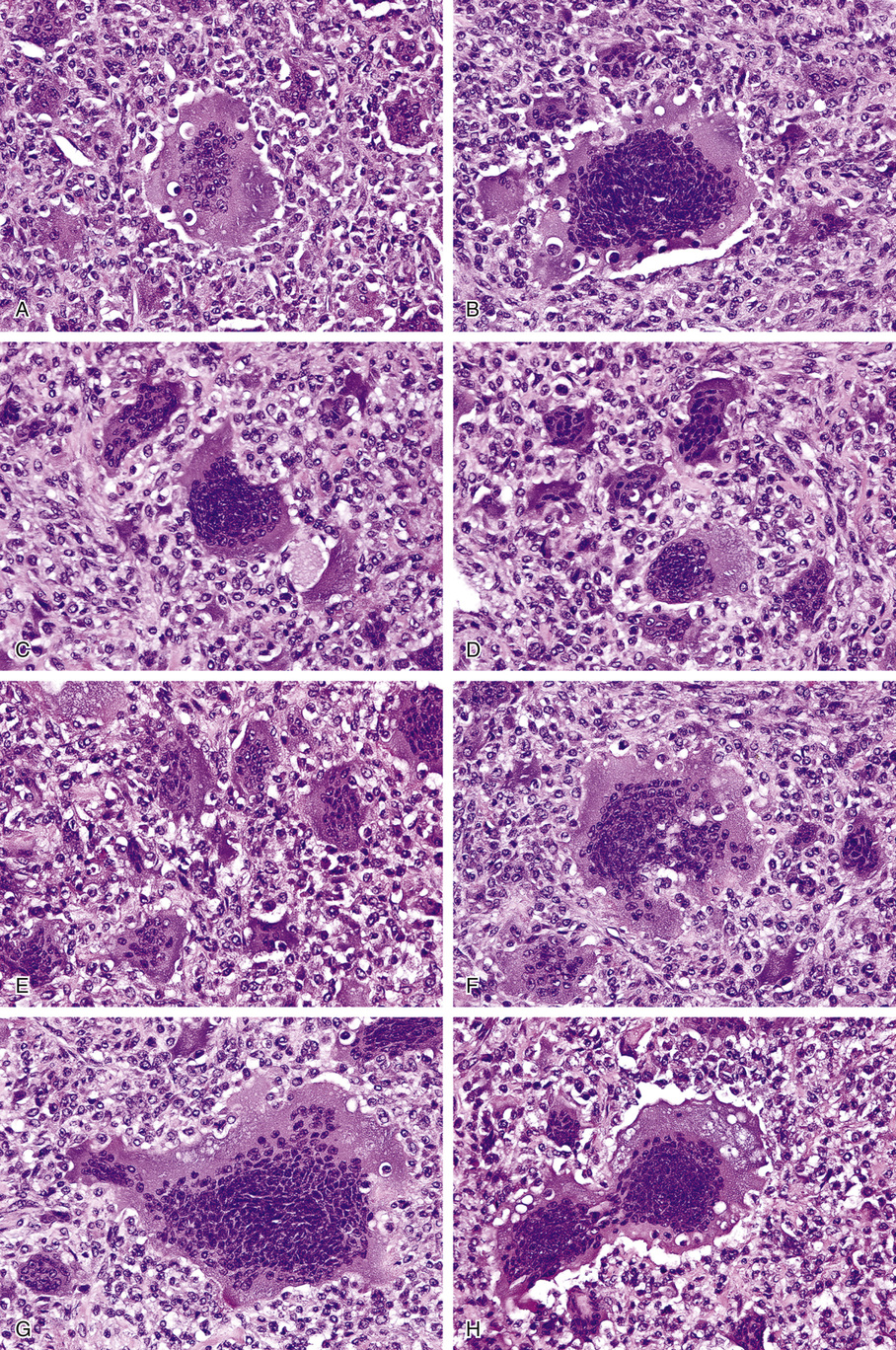 Giant Cell Lesions Basicmedical Key