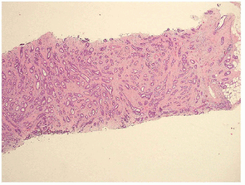 Invasive Carcinoma Special Types And Important Considerations