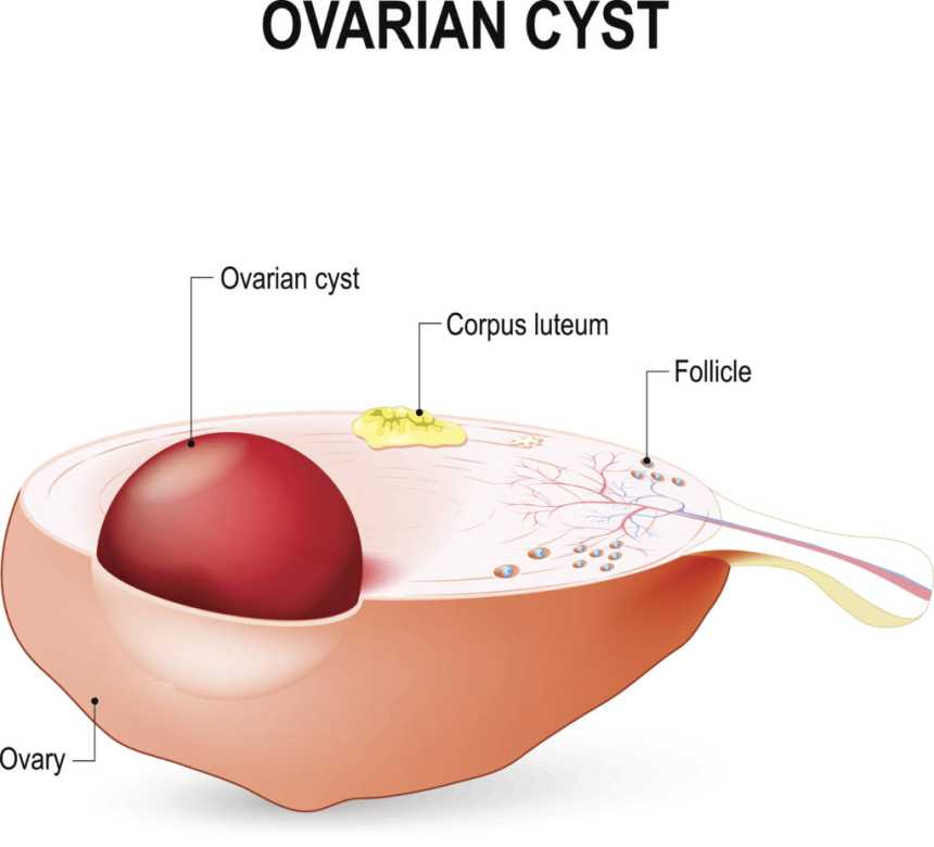 The 6 Types Of Ovarian Cysts And What You Can Do About Them