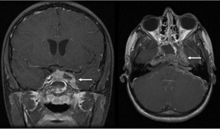 Cavernous Sinus Thrombosis Diagnosis And Treatment County Em