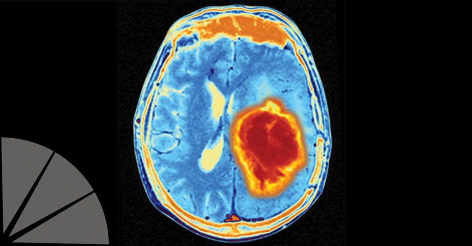 Ubicación Y Propagación De Metástasis Cerebrales Relacionadas Con El