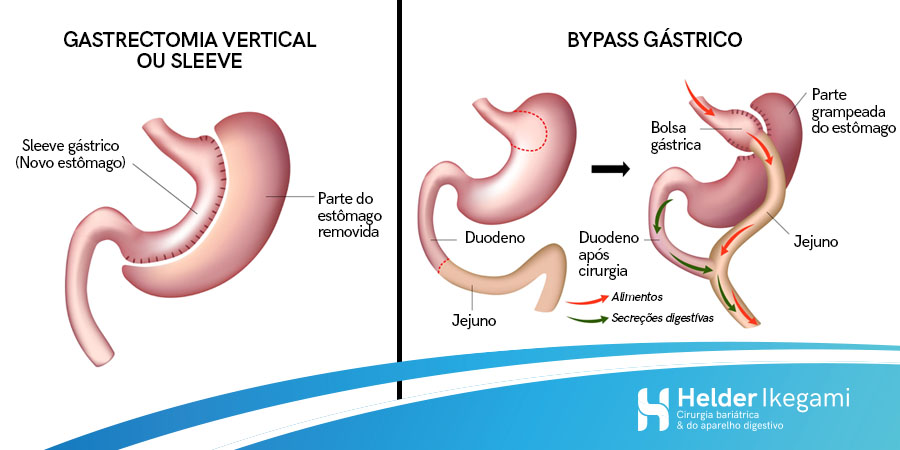 As Diferenças Entre As Técnicas De Cirurgia Bariátrica Bypass E Sleeve