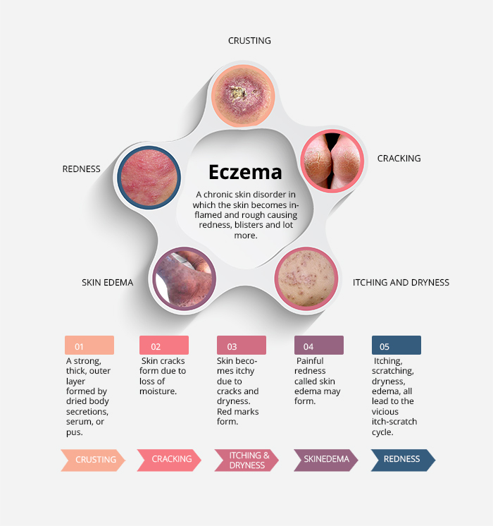 Eczema Molluscatum Viral Infection In Patients With Atopic Dermatitis