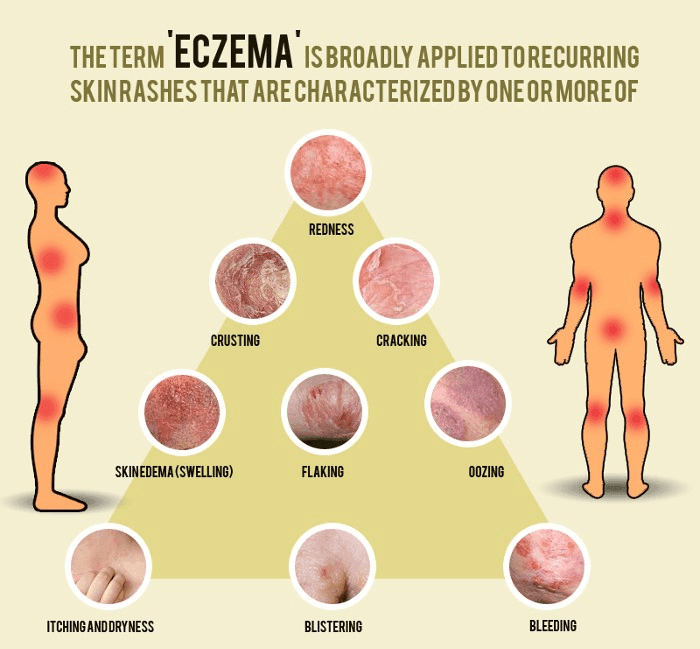 Álbumes 98 Foto Como Eliminar La Dermatitis Por Estasis Cena Hermosa