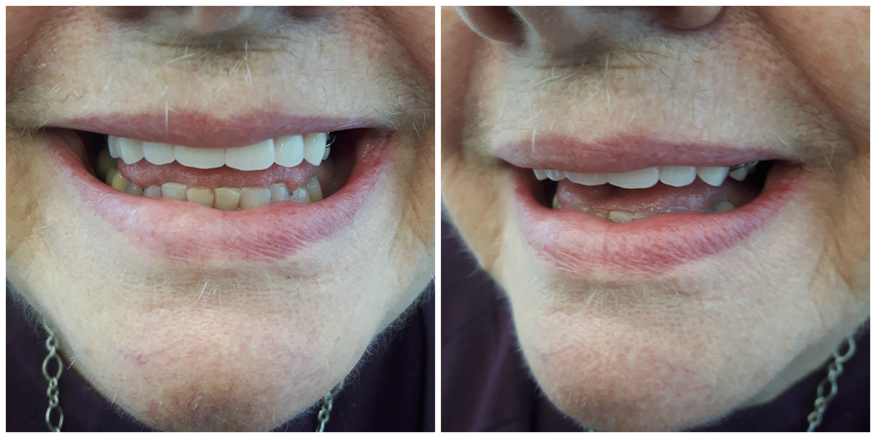 Partial Upper Denture Kelowna Denture Clinic