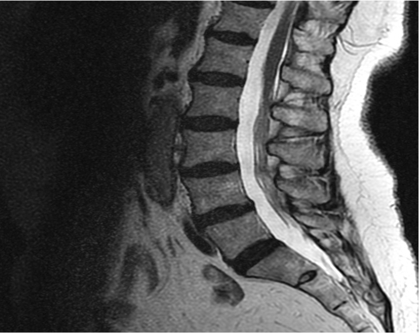 Healthcare Extreme How To Read An Mri Lumbar Spine In 8 Easy Steps