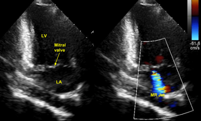 Mitral Valve Prolapse With Regurgitation Echocardiogram All About