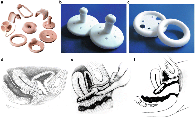 Pessary Ring With Support Removal Zonevardbregoli