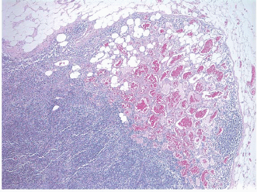 Axillary Lymph Nodes Oncohema Key