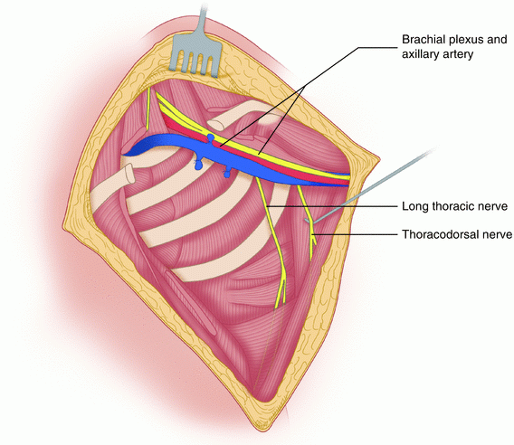 In Continuity Axillary And Supraclavicular Node Dissection Oncohema Key