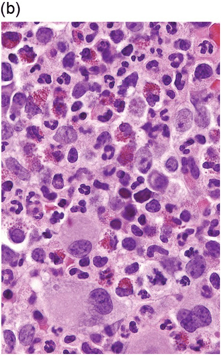 Chapter 11 Myelodysplasticmyeloproliferative Neoplasms Oncohema Key