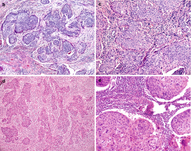 Squamous Cell Carcinoma Of The Cervix Obgyn Key