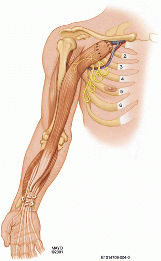 Traumatic Brachial Plexus Injury In The Pediatric Population Obgyn Key