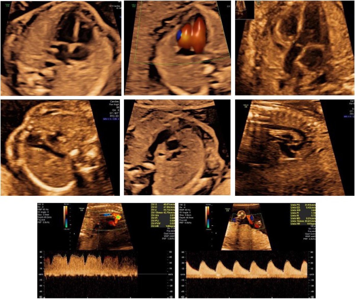 Second Trimester Cardiovascular Biometry In Growth Restricted Fetuses