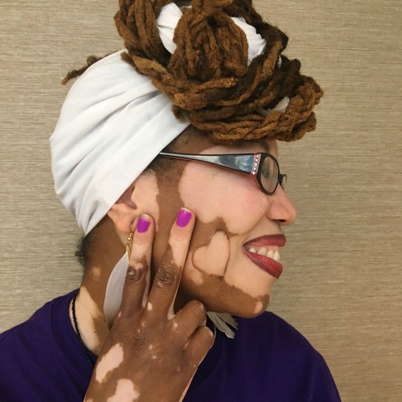 11 Things To Know About World Vitiligo Day 2019 June 21 23