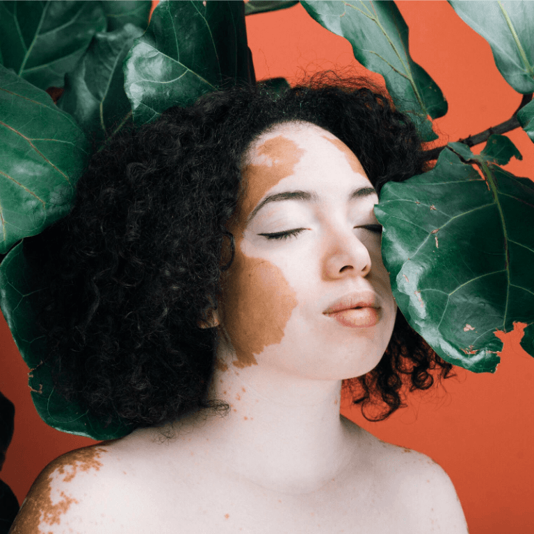 How Photography Instilled A Sense Of Confidence For This Vitiligo Model