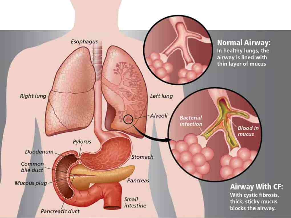 Cystic Fibrosis