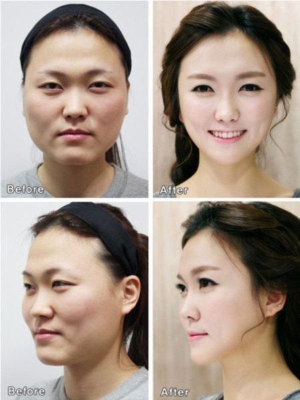 Young Koreans Before And After Extreme Plastic Surgery 50 Pictures