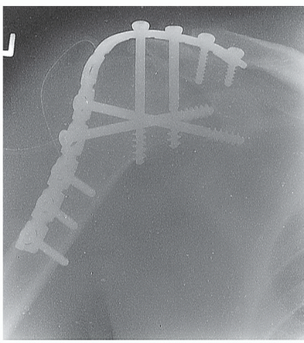 Arthroscopic Treatment Of The Arthritic Shoulder Musculoskeletal Key