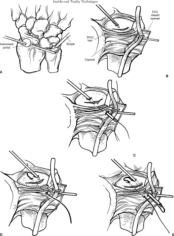 Peripheral Tear Of The Triangular Fibrocartilage Complex From The Ulna