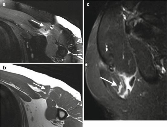 Pectoralis Major Injury Musculoskeletal Key