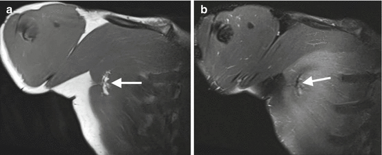 Pectoralis Major Injury Musculoskeletal Key