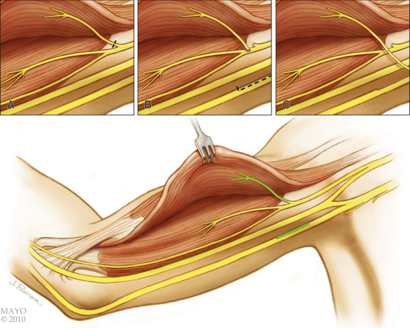 Brachial Plexus Injury Adult