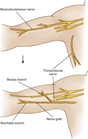 Nerve Transfers Musculoskeletal Key