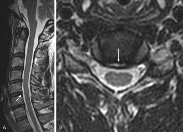 Magnetic Resonance Imaging Of The Cervical Spine Musculoskeletal Key