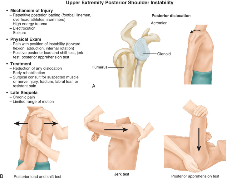 Posterior Shoulder Instability Musculoskeletal Key