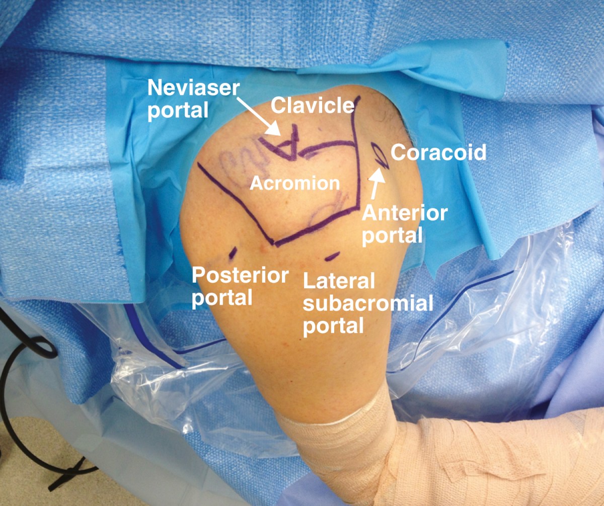 Arthroscopic Anatomy Of The Shoulder And Cuff Musculoskeletal Key