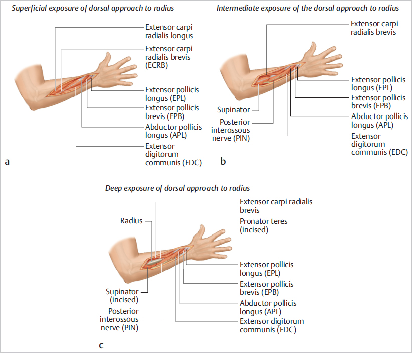 27 Radius And Ulna Shaft Fractures Musculoskeletal Key