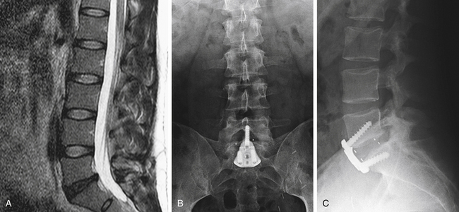 Anterior Lumbar Interbody Fusion Neupsy Key