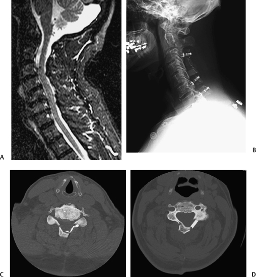 Degenerative Cervical Spine Disorders Surgical And Nonsurgical