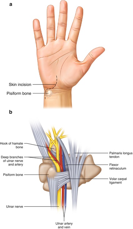 Nerve Entrapment At Shoulder And Arm Neupsy Key