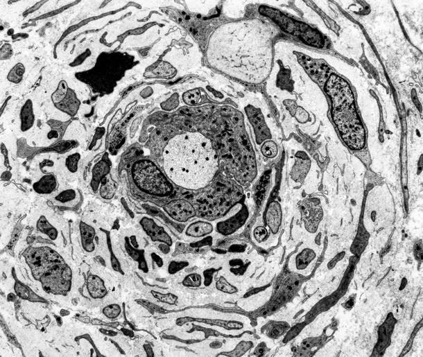 The Inflammatory Demyelinating Neuropathies Neupsy Key