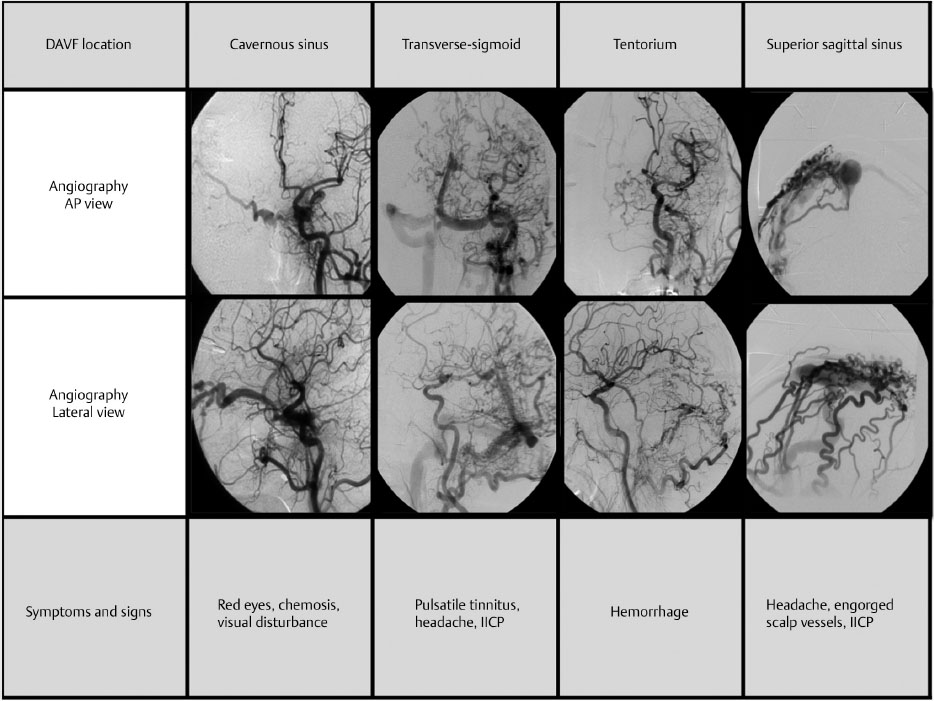 Radiosurgery For Dural Arteriovenous Fistulas Indications And Outcomes