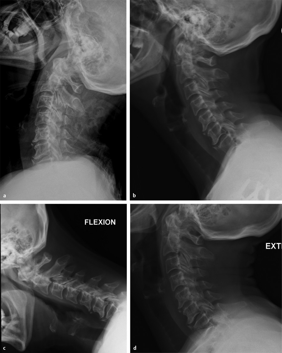 Nonoperative Management And Treatment Of Cervical Spine Injuries