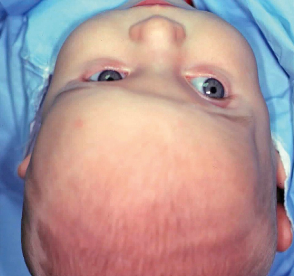 Unicoronal Craniosynostosis Neupsy Key