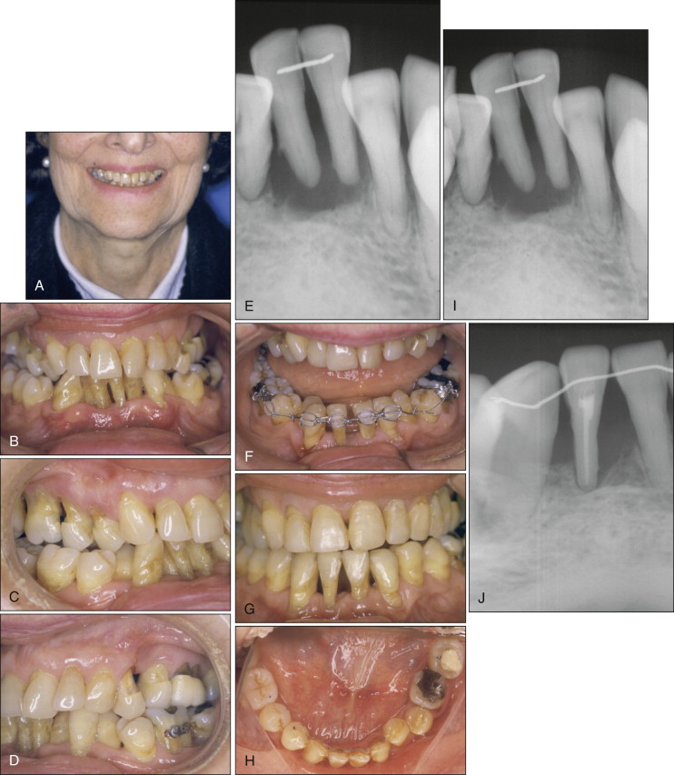 Orthodontic Treatment In Adult Patients With Reduced Periodontal
