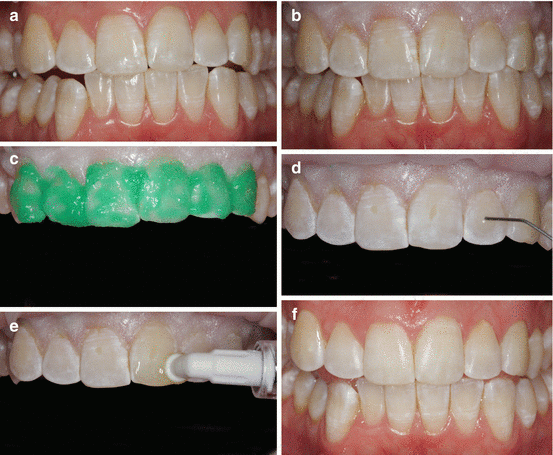 Resin Infiltration After Enamel Etching Pocket Dentistry